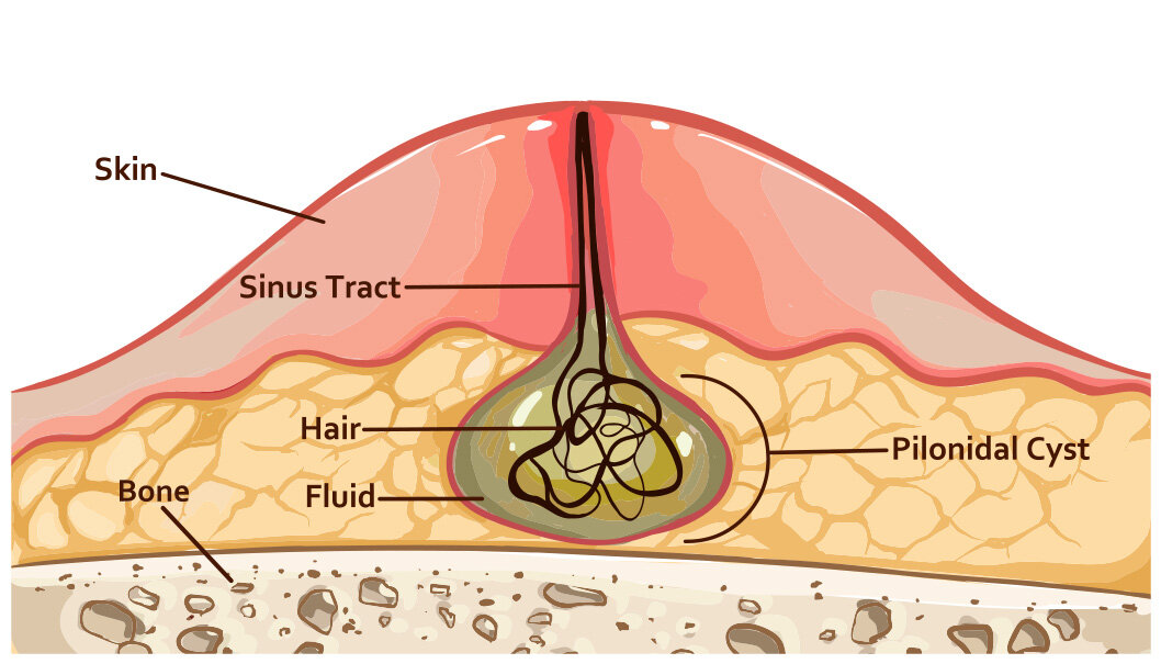 Infected Pilonidal Cyst Abscess Infected Pilonidal Cyst Abscess